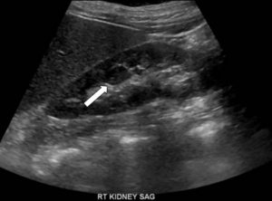 CEUS Excludes Kidney Mass - International Contrast Ultrasound Society