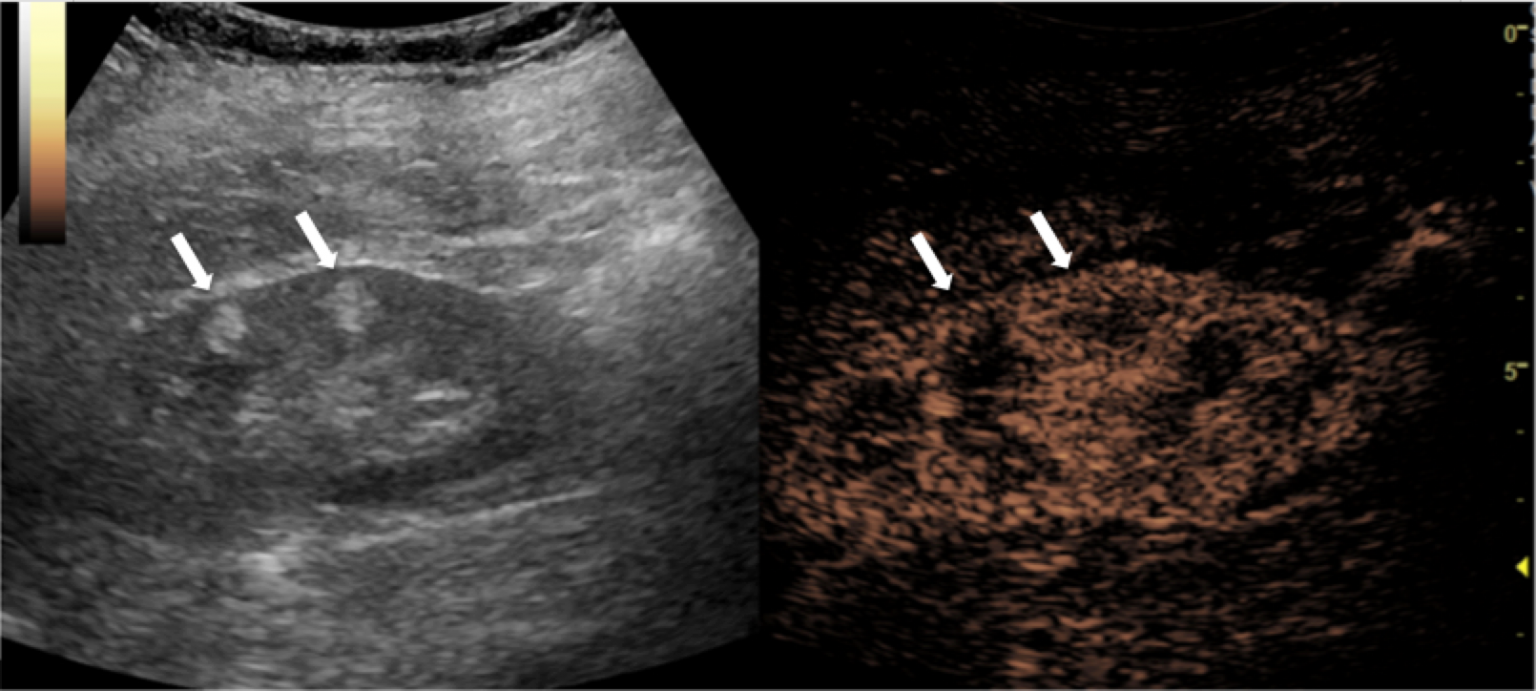 Body Imaging - Kidney - International Contrast Ultrasound Society