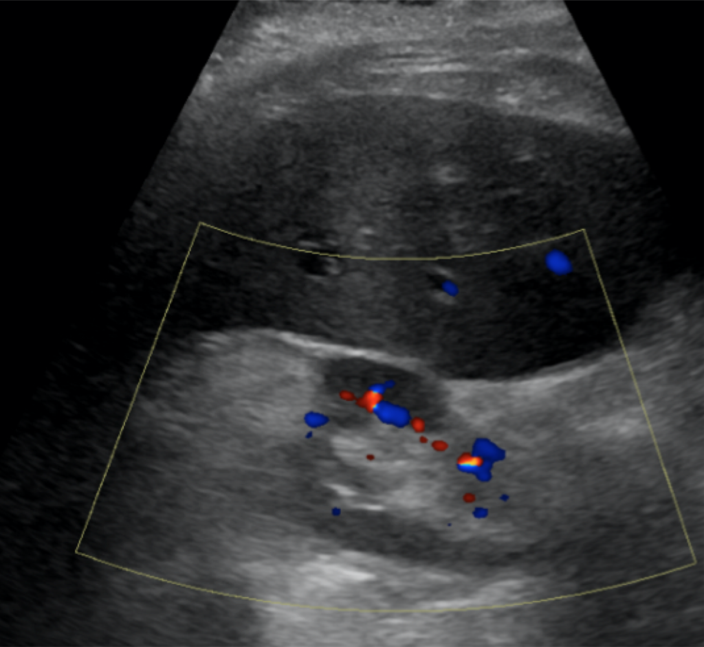 Body Imaging - Kidney - International Contrast Ultrasound Society