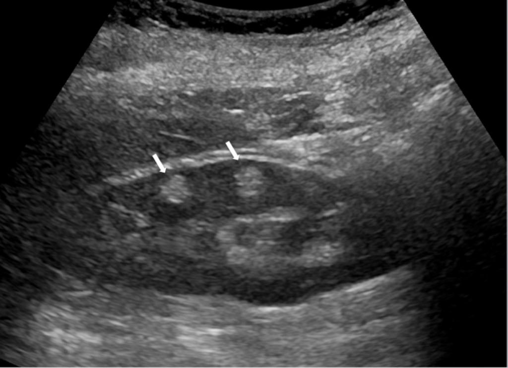 Body Imaging - Kidney - International Contrast Ultrasound Society