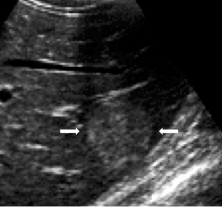 Body Imaging - Liver - International Contrast Ultrasound Society
