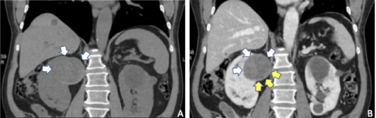 CEUS provides clarity on diagnosis of malignant kidney tumor ...