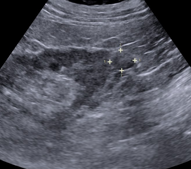 Case of the Day: Name that Renal Mass, the importance of CEUS ...