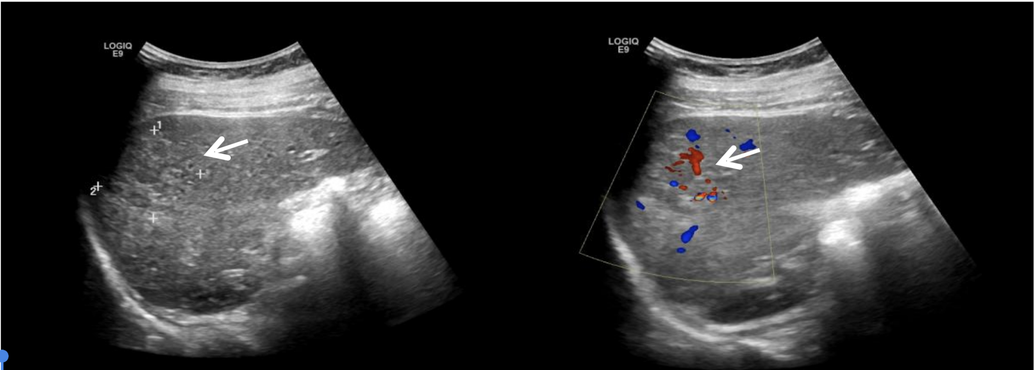 CEUS reveals benign liver mass after CT and MRI suggest malignancy ...