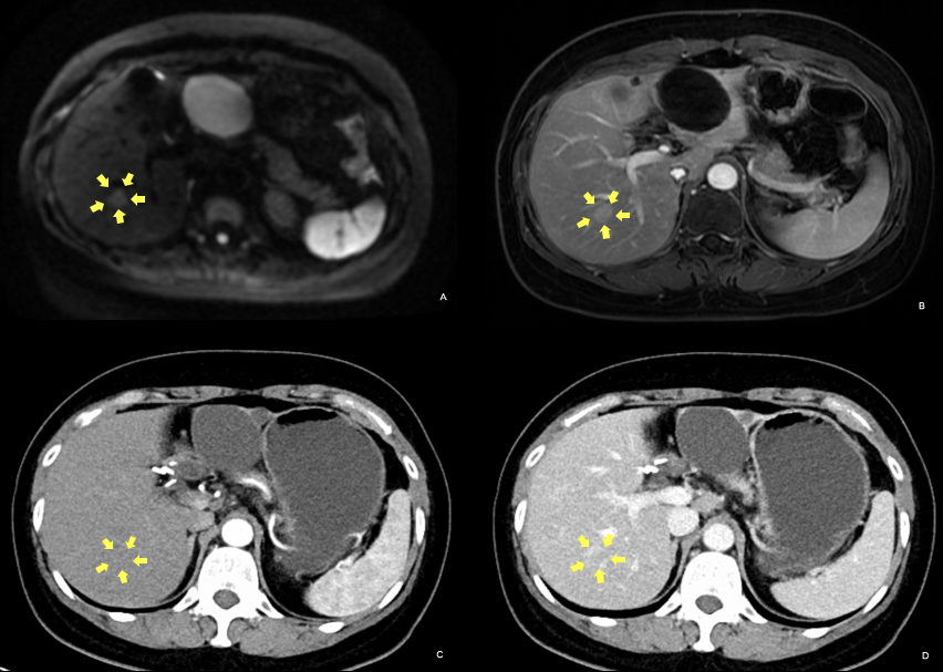 CEUS rules out metastatic liver cancer and helps woman avoid ...